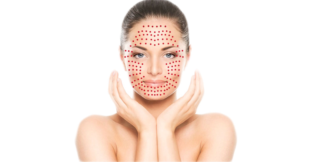 Dermapen - Vampire Lift - Face and Body Clinic